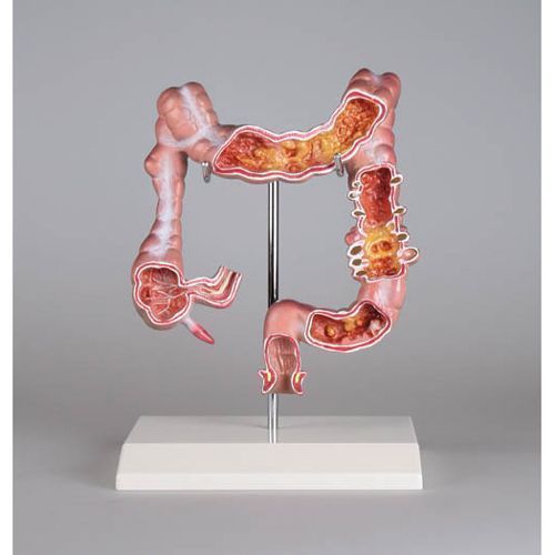 Modèle d'intestin avec les maladies Erler Zimmer à 80,99 € | Matériel ...